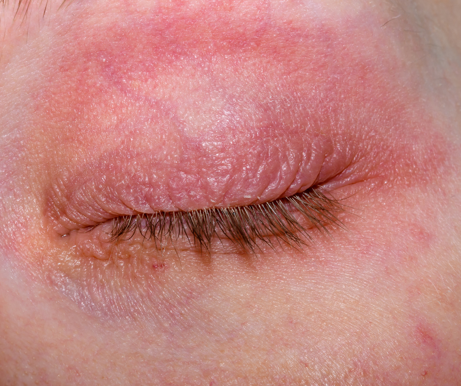 Olhos Com Dermatite Atopica